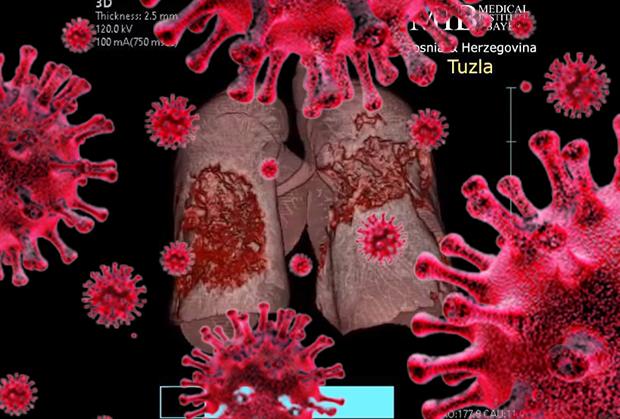 OVO JE CT SNIMAK PLUĆA POSLE TEŠKE INFEKCIJE! Evo šta KORONA VIRUS može ...