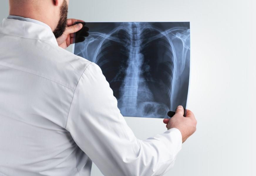 Koji su simptomi tuberkuloze | Kurir