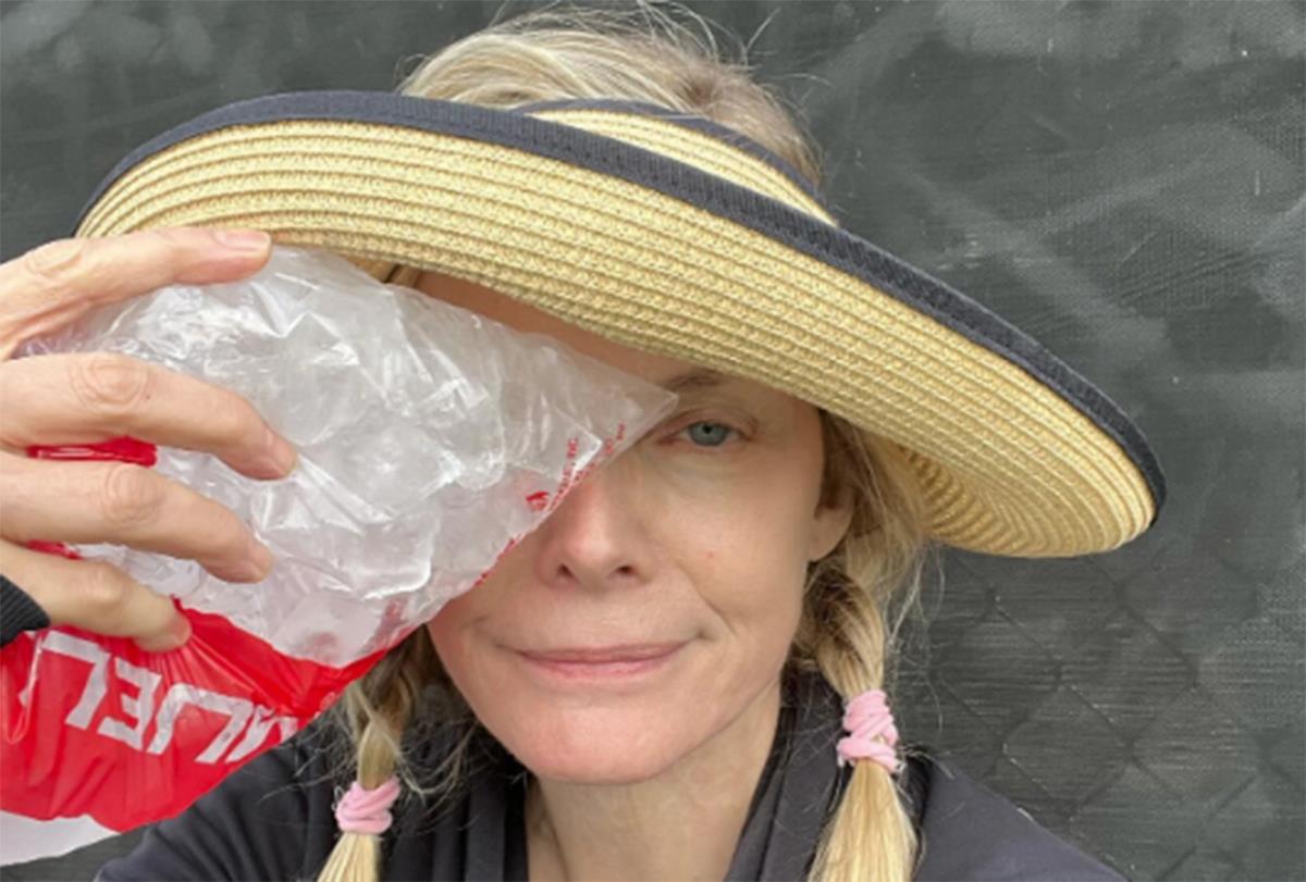 Mišel Fajfer objavila fotografije s ogromnom modricom na oku | Kurir