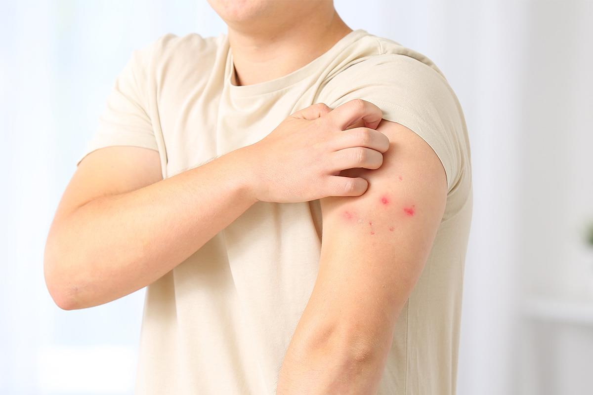 Kako se prenose male boginje - morbile | Kurir