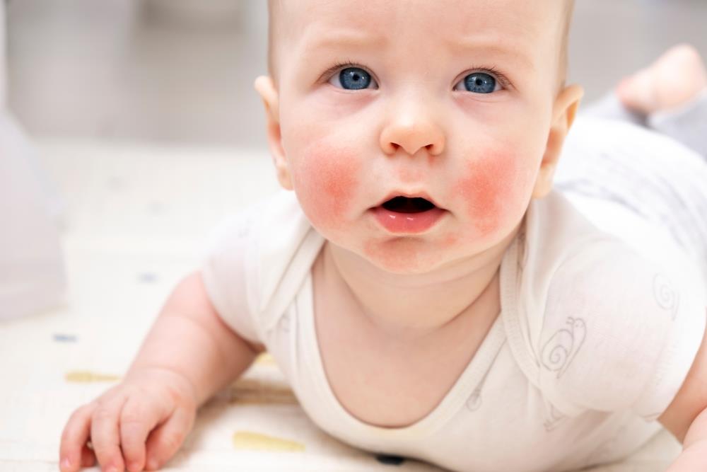 Osip kod beba može ukazivati i na ozbiljnije probleme | Zdravlje Kurir