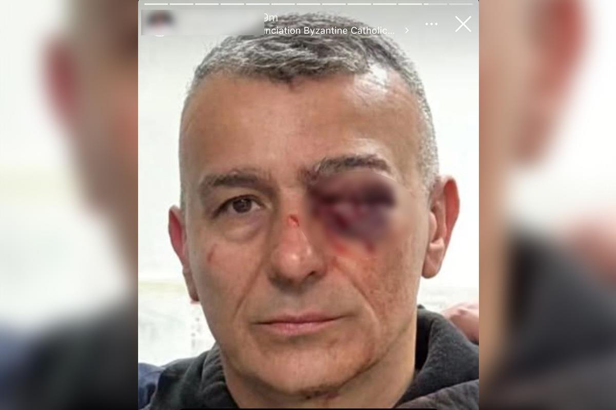 Lice hrabrog policajca Lazara je lice žrtve siledžijske Srbije Mučki udaren bokserom! Vučević ...