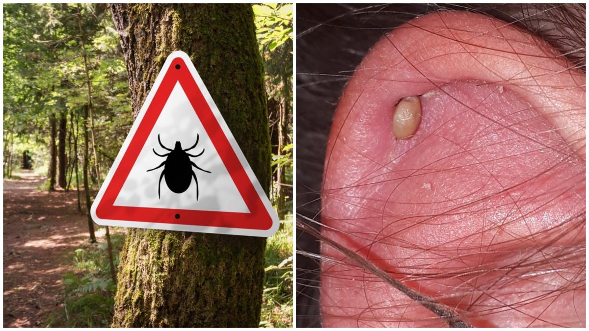 Detetu se krpelji zakačili za uši | Kurir