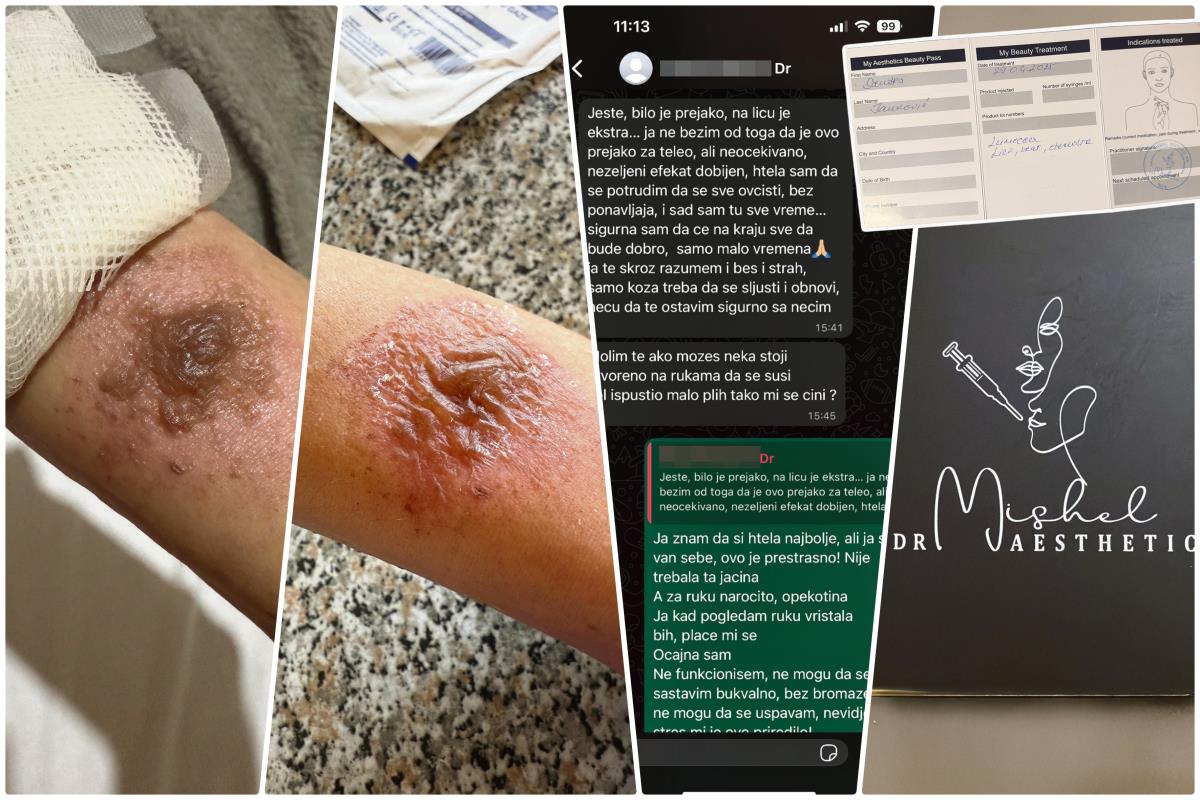 Nišlijka otišla u privatnu kliniku da skine fleke od sunca pa dobila opekotine od lasera | Kurir