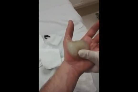 MOMAK JE ISCEDIO OGROMAN ŽULJ NA RUCI: Kliknite sada, kajaćete se ...