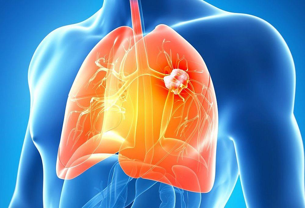SIMPTOMI KOJI UKAZUJU NA RAK PLUĆA: Evo kako otkriti podmuklu bolest na ...